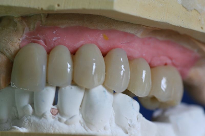 Plaque dentaire Viry Châtillon | Restauration, prothèse dentaire Paris