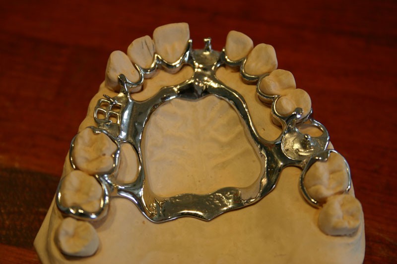 Stellite dentaire, couronne dentaire Viry-Châtillon, Juvisy-sur-Orge ...