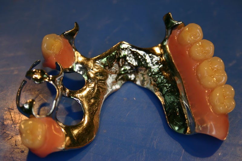 Stellite dentaire, couronne dentaire Viry-Châtillon, Juvisy-sur-Orge ...